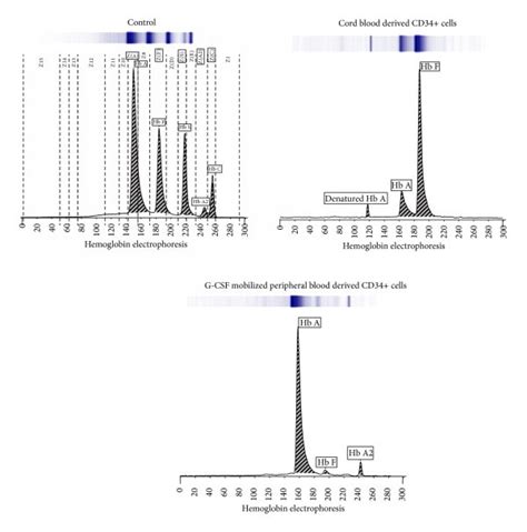Electrophoretic Determination Of Main Hemoglobin Subtypes In