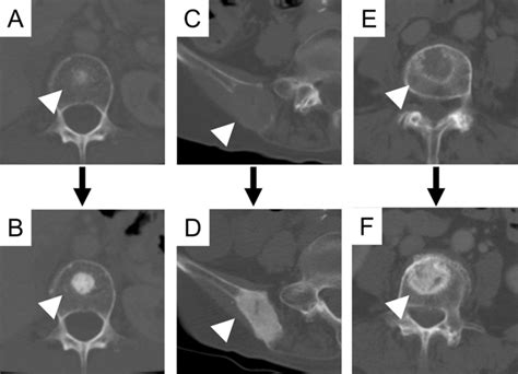 The Typical Example Of Each Pattern Of Osteoblastic Bone Reaction Download Scientific Diagram
