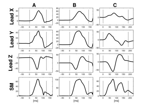 P Wave Ecg Pulsenotes P Wave Qrs And Qt Interval