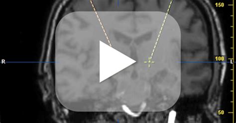 Deep Brain Stimulation In Essential Tremor Tidsskrift For Den Norske Legeforening