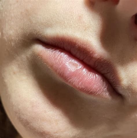Healing Lip Scar Rdermatologyquestions