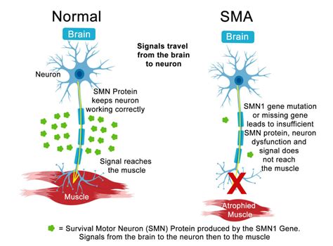 Spinal Muscular Atrophy Sma Types Causes Symptoms And Treatment