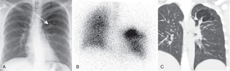 Congenital Thoracic Malformations Clinical Tree