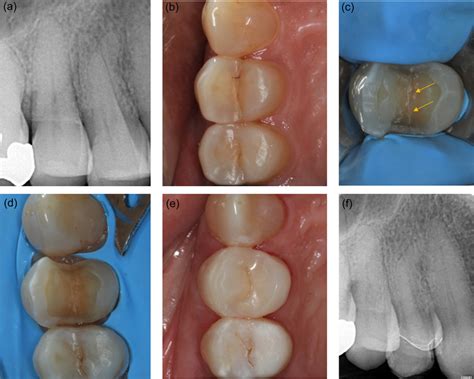 Indirect Composite Onlay Restoration In An Intact Cracked 14 With
