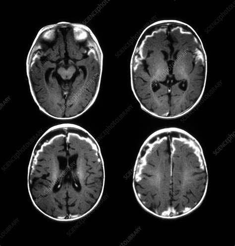 Mri Of Meningitis Stock Image M2100404 Science Photo Library