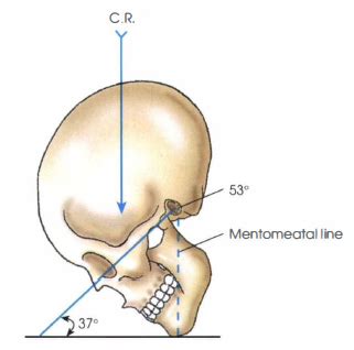 Facial Bones X Ray Parietoacantial Projection Radtechonduty