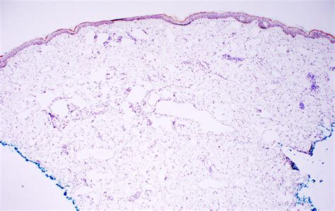 Pathology Outlines Atypical Vascular Proliferation
