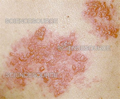 Herpes Zoster Rash Stock Image Science Source Images