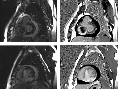 Dramatic Presentation Of Cardiac Pleomorphic Liposarcoma Circulation