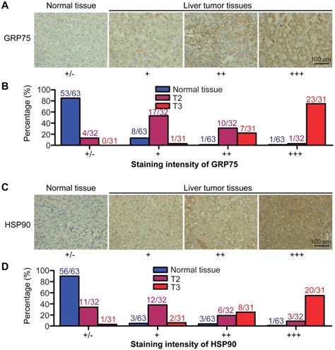 Tumor Tissue Arrays Containing 63 Pairs Of Non Tumor And Hcc Tissues