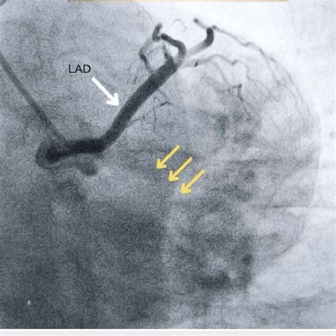 Ap Caudal View Showing Lad White Arrow And Absent Lcx Yellow Download Scientific Diagram