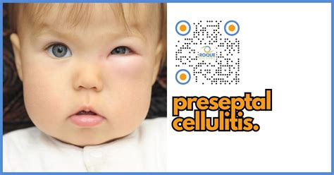Periorbital Cellulitis Contagious