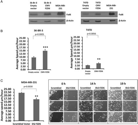 Functional And Prognostic Significance Of The Genomic Amplification Of Frizzled 6 Fzd6 In