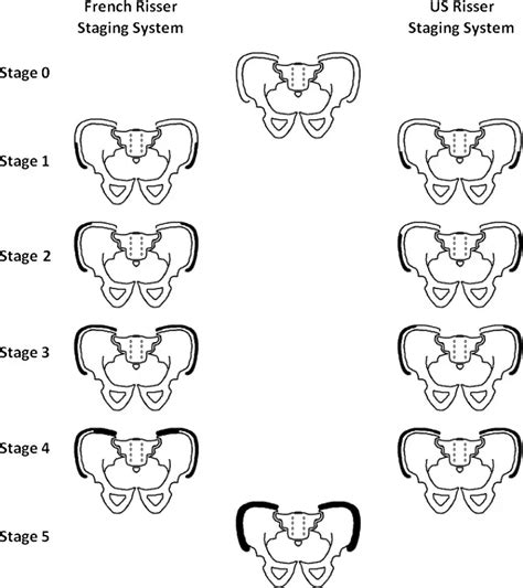 Test De Risser Classification Et Interprétation Scoliose Lombafit