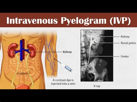 What Is An Intravenous Pyelogram Ivp G U Imaging Ivp Normal