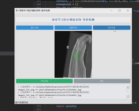 毕业设计 Yolov11骨折检测医疗辅助系统（源码论文） Csdn博客