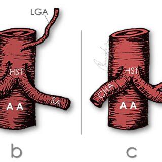 The Most Common Anatomical Variations Of Ct The Celiac Trunk A The