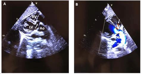 Case Of Large Perimembranous Vsd That Completely Closed Spontaneously Download Scientific