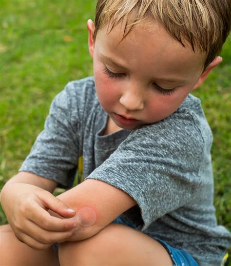 Sarna Bug Bite Patches With Skin Soothing Ingredients