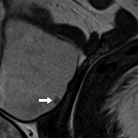 Inverted Papilloma Bladder Urothelial Carcinoma