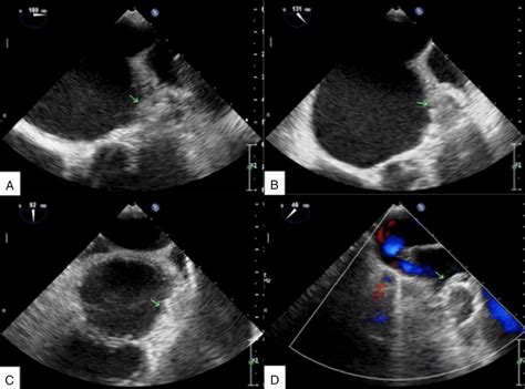 Verification At Different Angles After Watchman Device Implantation Download Scientific