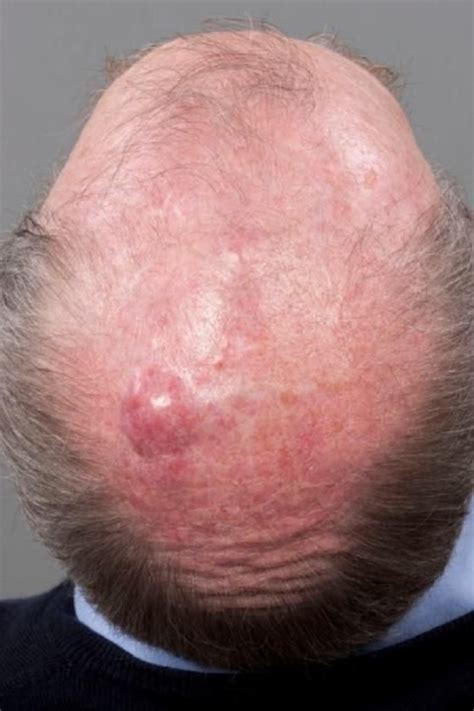 Skin Cutaneous B Cell Lymphoma Artofit