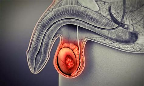 Quiste De Epidídimo Médicos Urólogos Y Cirugía 😊😊