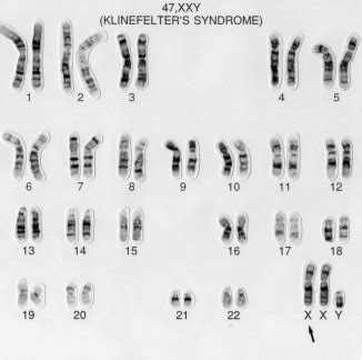 Sex Chromosome Abnormalities