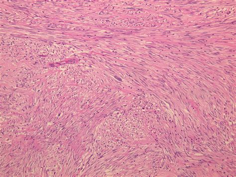 103 消化管間葉性腫瘍 Gist （消化器系2 その12） 滋賀医科大学 病理学講座 人体病理学部門