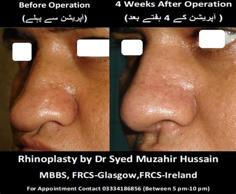 Removal Of Frontal Pyocele Dr Syed Muzahir