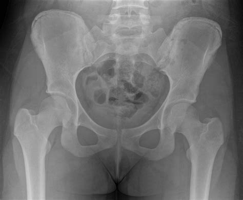 Pelvis Anatomy Xray
