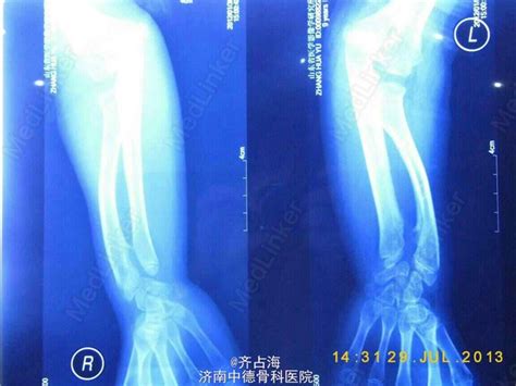 先天性四肢畸形 医联
