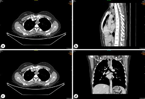 Figure 1 From Ewing Sarcoma And Primitive Neuroectodermal Tumor Of The Thoracic Esophagus Case