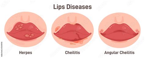 Human Lips Disease Herpes Cheilitis And Angular Cheilitis Sores Inflammation Stock Vector