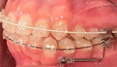 Mini Implants Tads Iqdent