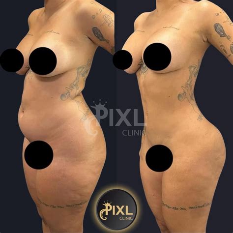 Liposuction Before And After Pixl Clinic