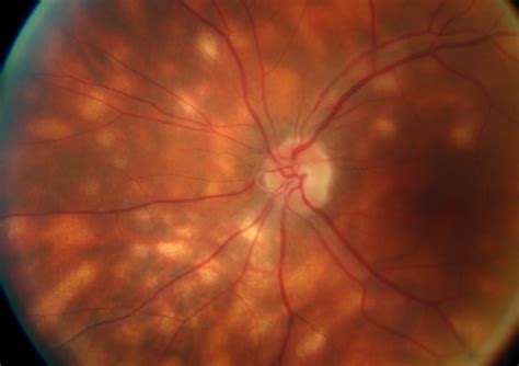 Asymptomatic Patient Has Hypopigmented Spots In The Retina