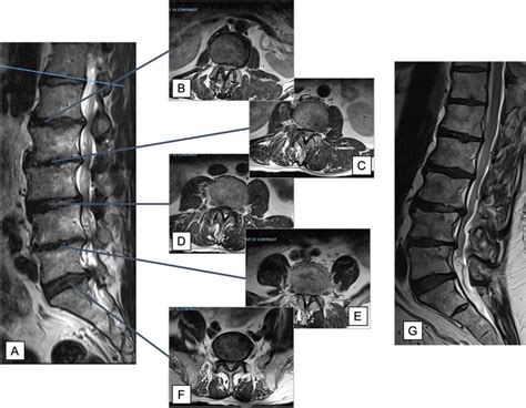Case Example Of Multilevel Segmental Lumbar Spinal Stenosis Note The Download Scientific