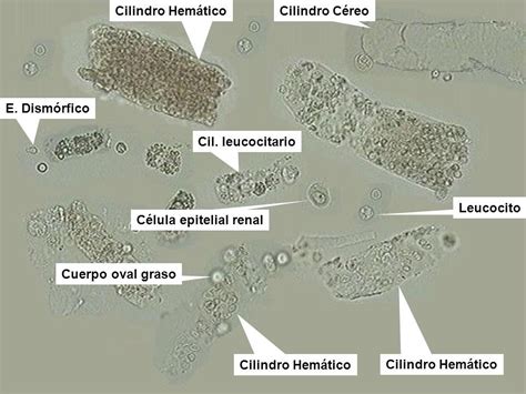 Sedimento Urinario Buscar Con Google My XXX Hot Girl