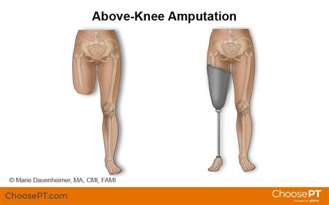 Guide Physical Therapy Guide To Above Knee Amputation Transfemoral Amputation Choose Pt