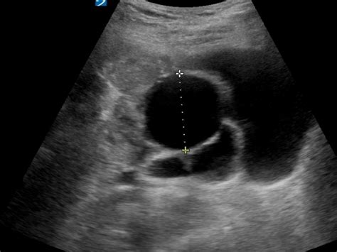 Ovary And Appendix Location