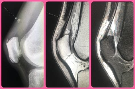 Quadriceps Tendon Calcification