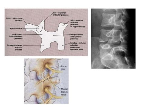 Lumbar Facet Syndrome Ppt