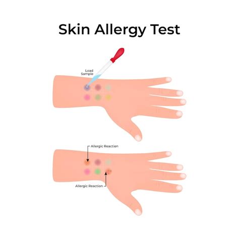 Drug Allergy Testing Vectors Download Free High Quality Vectors From