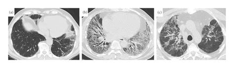 A Radiographic Probable Uip Pattern Patient 1 B Radiographic