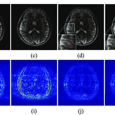 performance of algorithms under cartesian undersampling scheme at 35