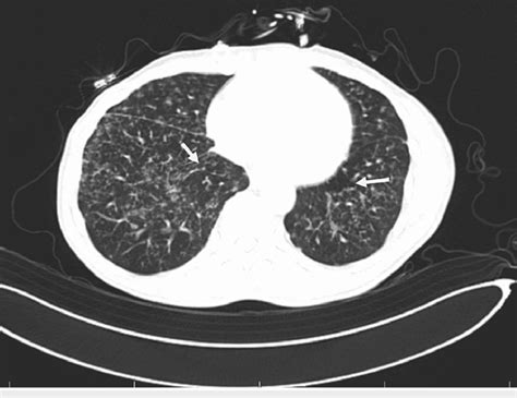 Ct Of The Chest On Presentation White Arrows Show Extensive Bilateral Download Scientific