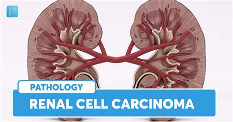 Comprehensive Guide To Renal Cell Carcinoma