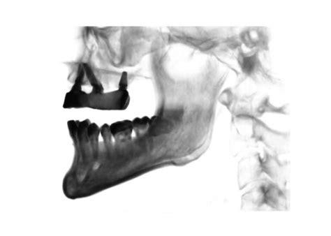 The Perks Of A Palatal Root Aox Surgery