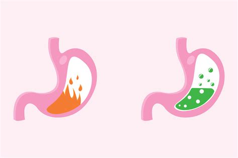 Ilustración De Pirosis Estómago Y Náusea Estómago Pirosis Fuego
